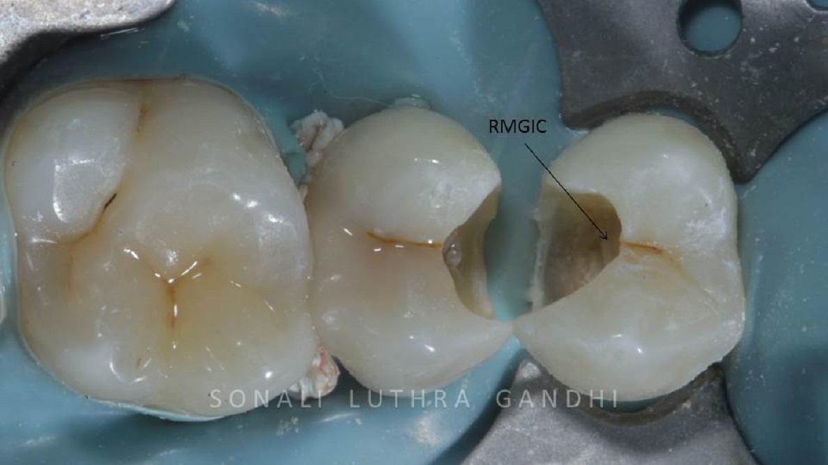 Management of proximal posterior lesions: A case report