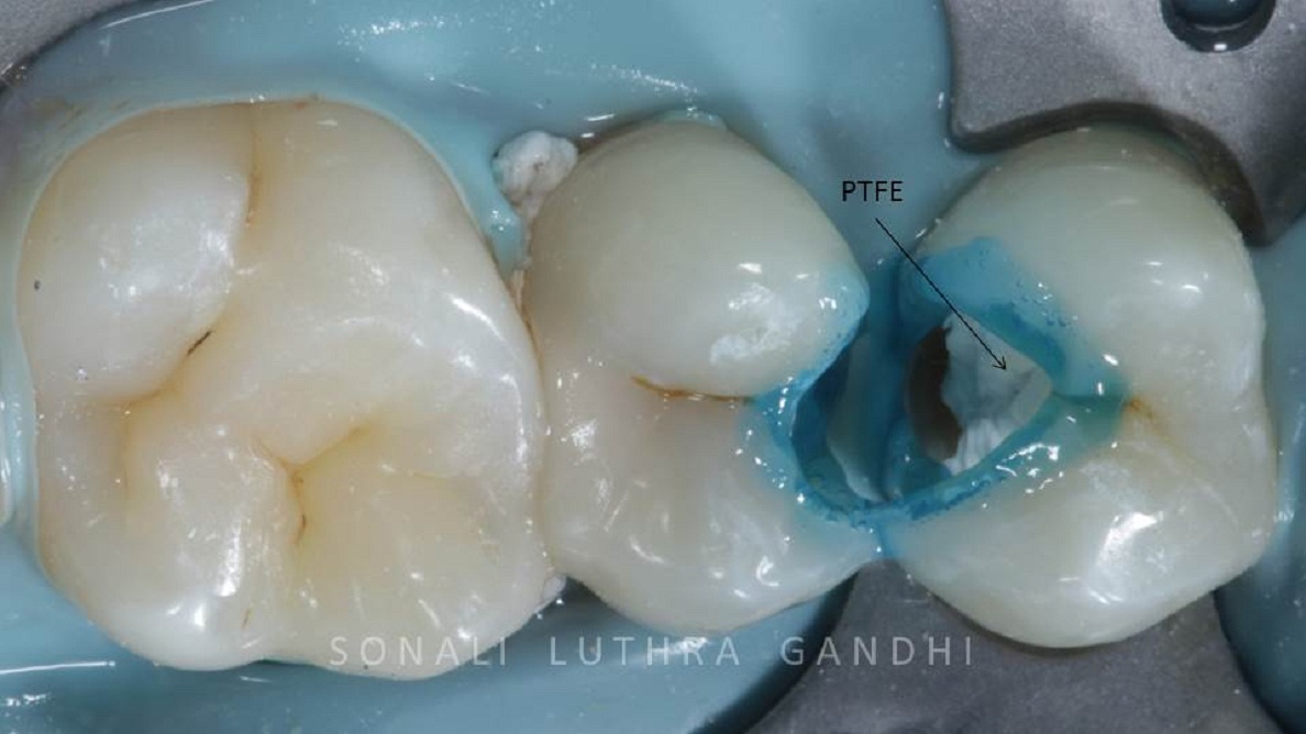 Management of proximal posterior lesions: A case report